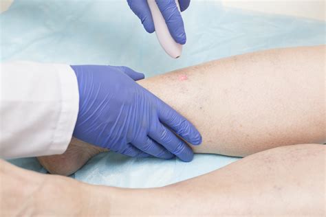 Is Laser Vein Treatment Right For Me Grand Junction Vein Center