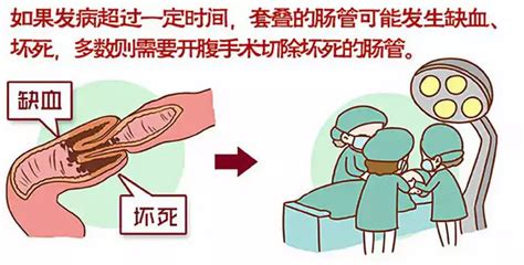 同样是肚子疼，宝宝肠绞痛、肠套叠可不一样！家长们要引起重视！ 知乎