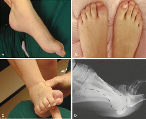 Lesser Toe Deformities Clinical Tree