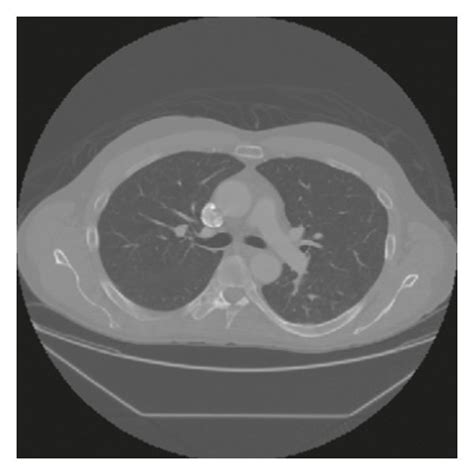Some Steps In The Extraction Process Of Lung Nodules Download