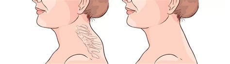 Best Treatment For Dowagers Hump Pain Relief Cincinnati Ohio