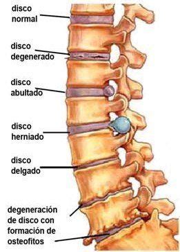Espondiloartrosis qué es causas y tratamiento Demedicina