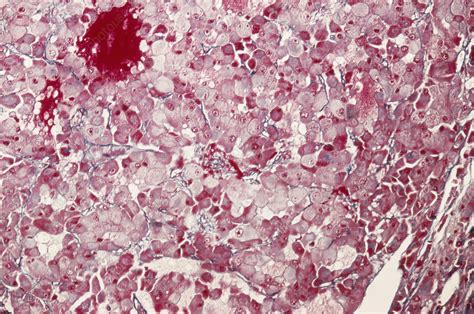 Adrenal Gland Tumour Stock Image M1300689 Science Photo Library