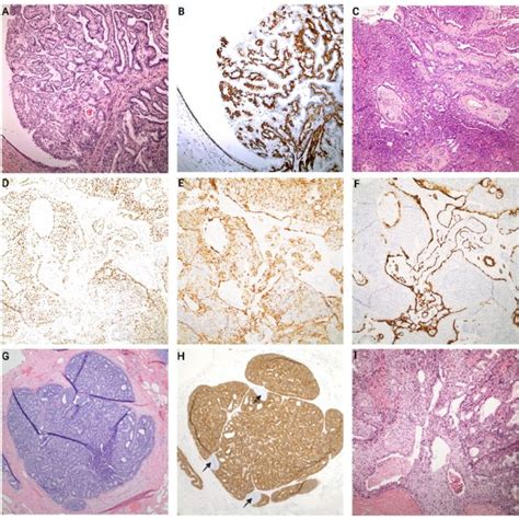 A Encapsulated Papillary Carcinoma Epc B Cystic Epc C Invasive