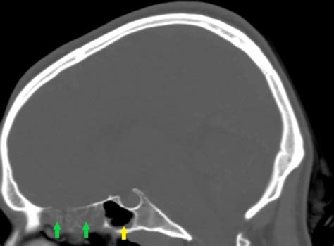 Mycoplasma Pneumoniae Induced Rash And Mucositis With Bilateral Otitis