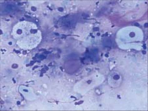 Pleomorphic Adenoma With Squamous And Appendageal Metaplasia Mimicking