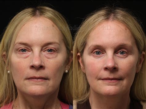 Before And Four Weeks After After Upper And Lower Blepharoplasty