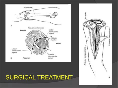 Chronic Exertional Compartment Syndrome University Of Florida Ppt