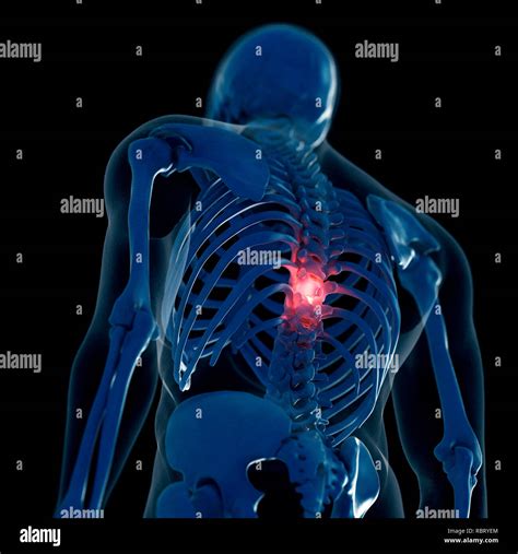 Illustration Of A Painful Thoracic Spine Stock Photo Alamy