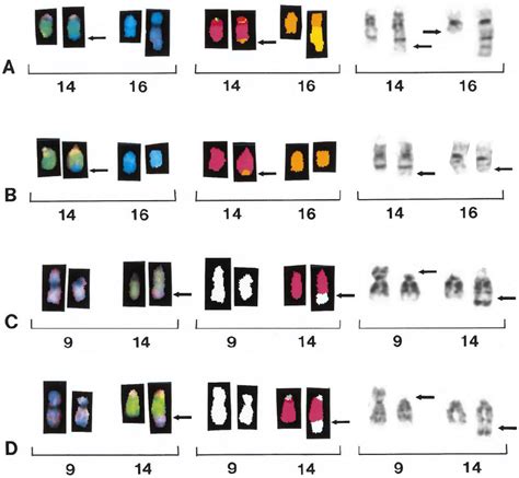 Partial Karyotypes From Four Different Patients Showing Recurring