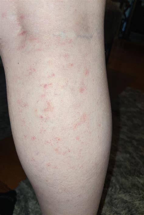 Non Raised Non Itchy Rash I Have This Rash Behind My Knees And Torso