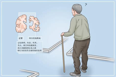 世界阿尔茨海默病日 知己知彼 早防早智携手向未来 青岛新闻网