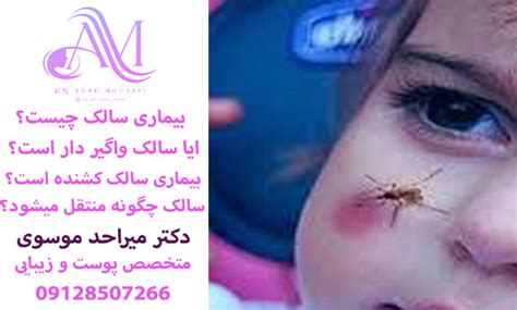 بیماری سالک یا لیشمانیوز 0 تا 100 درمان و علائم و تشخیص سالک