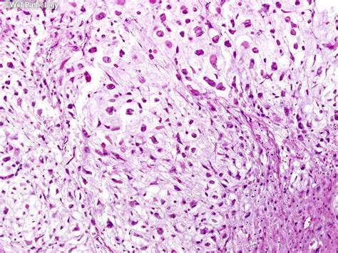 Chondrosarcoma Grade Iii