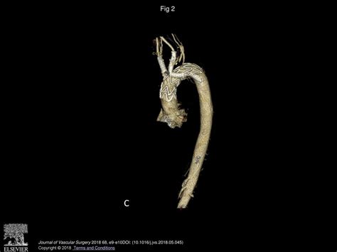 Hybrid Endovascular Exclusion Of A Bleeding Innominate Artery