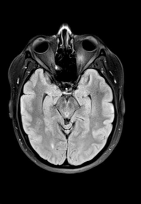 Is This A White Matter Lesion R Radiology