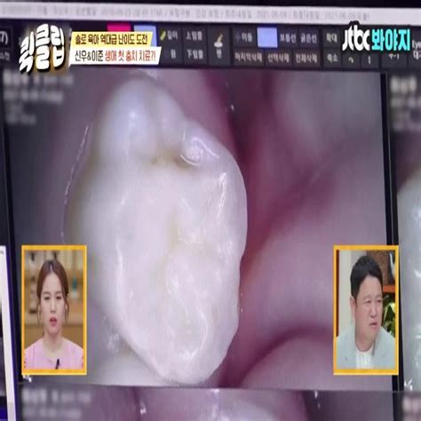 Cavity Object Detection Dataset And Pre Trained Model By Kim O Sans
