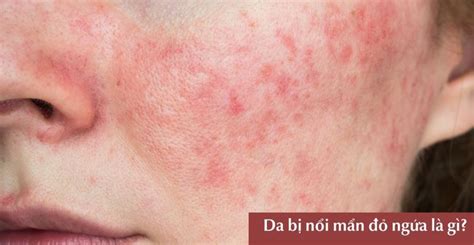 Da Nổi Mẩn Đỏ Ngứa Là Bị Làm Sao Và Xử Lý Như Thế Nào Eucerin