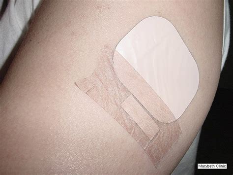 4 피부에 묻은 약물에 의한 알레르기접촉피부염 제3장 알레르기접촉피부염 네이버 블로그