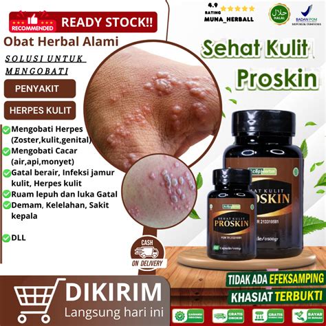 Jual Obat Herpes Kulit Salep Herpes Herpes Kelamin Herpes Bibir