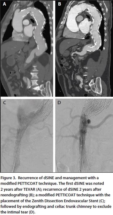Distal Stent GraftInduced New Entry Endovascular Today