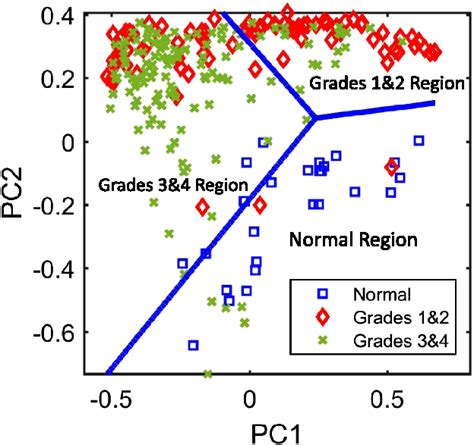 Optical Biopsy Identification And Grading Of Gliomas Using Label Free Visible Resonance Raman