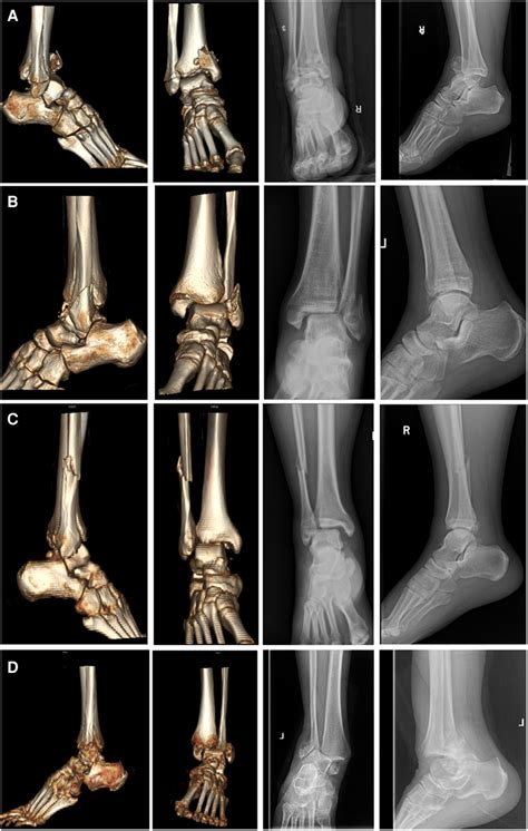 The Ct Reconstructions And Radiographs Of Ankle Fracture Dislocations