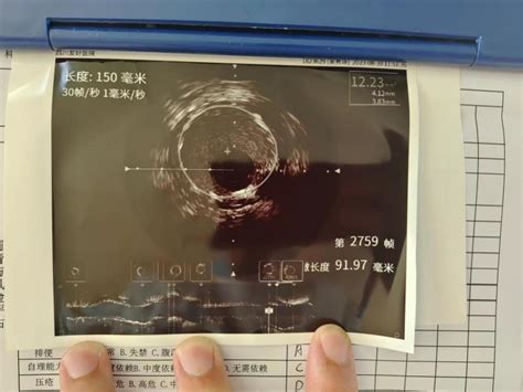 再创新高，精准治疗！我院心血管内科成功开展恩阳区首例ivus！新闻动态新闻中心四川友好医院