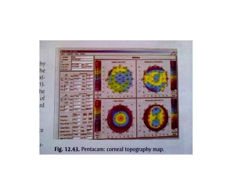 Corneal Topography Wavefront Analysis Pptx