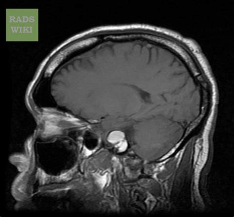 Cholesterol Granuloma Radiology At Nilsa Sutton Blog