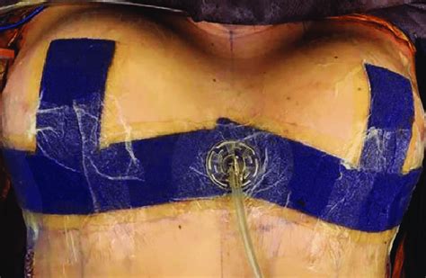 On Table Appearance After Skin Closure Of Wise Pattern Incisions And Download Scientific