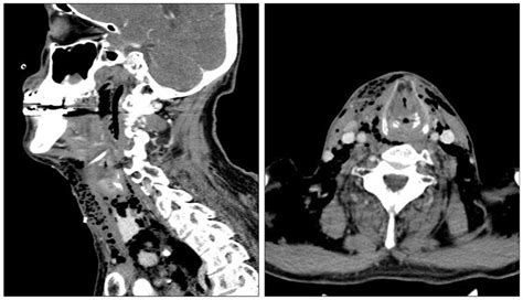 Preoperative Computed Tomography Scans Show A Large Amount Of Download Scientific Diagram