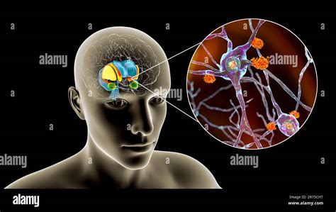 Dorsal Striatum And Lateral Ventricles In The Brain Of A Person With