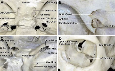 Anterior Clinoidectomy And Optic Nerve Decompression Cohen Collection