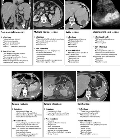 Imaging Features Of Splenic Diseases With Differential Diagnosis