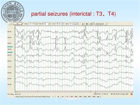 PPT Neuromuscular Disease 2 Epilepsy PowerPoint Presentation Free