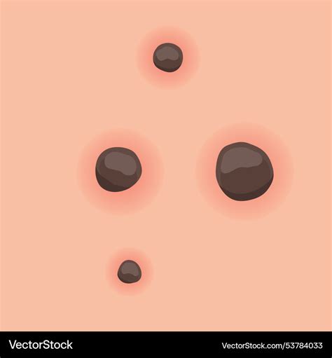 Understanding Type Of Acne A Comprehensive Visual Vector Image