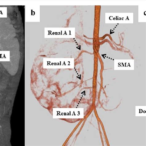 Preoperative Enhanced Ct Findings Download Scientific Diagram