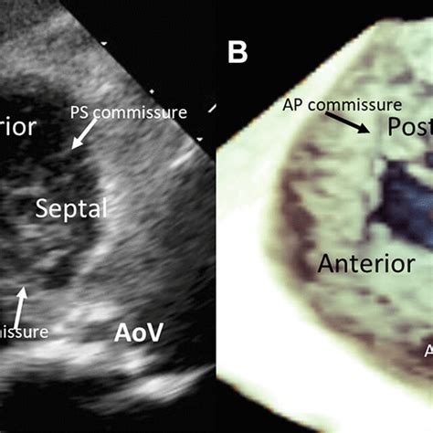 Visualization Of The Tricuspid Valve With 2 And 3 Dimensional
