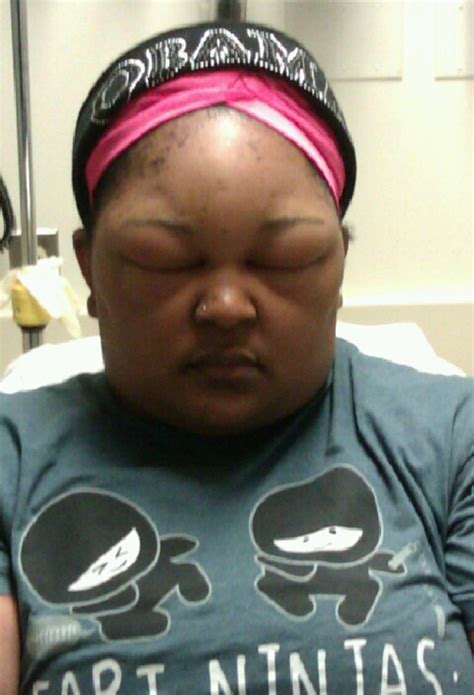 Allergic Reactions That Actually Hurt To Look At