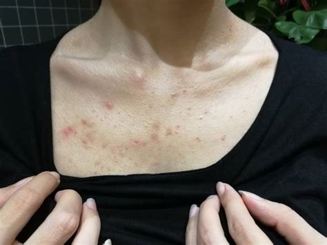 胸前毛孔堵塞 毛孔堵塞怎么疏通毛孔 伤感说说吧