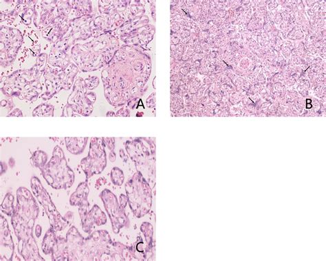Representative Microscopic Features Of Placenta In Our Case