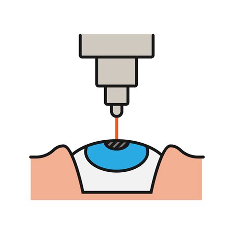 Can LASIK Eye Surgery Cure Astigmatism