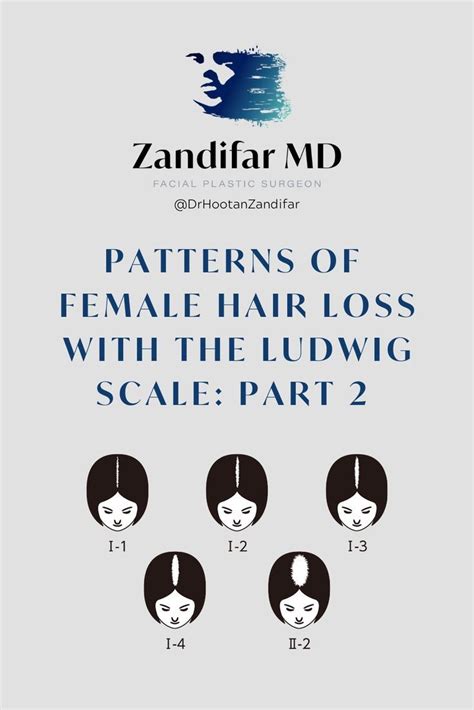 Female Hair Loss With The Ludwig Scale Hair Loss Women Hair Loss