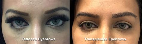 Hair Restoration Surgery Performed In Connecticut Ct And Western