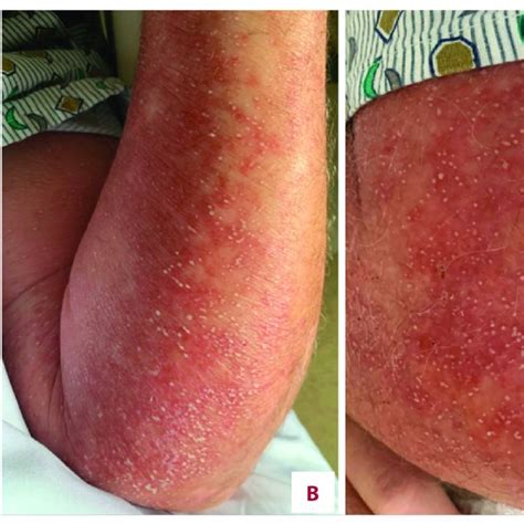 Clinical Presentation Acute Generalized Exanthematous Pustulosis With