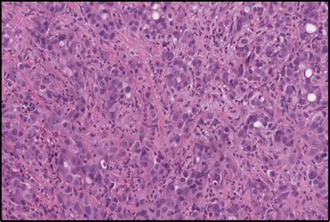 High Power Photomicrograph Showing Metastatic Cholangiocarcinoma