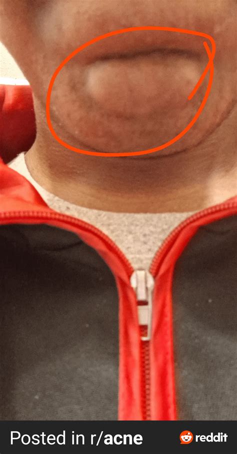 Weird Lumb And Mini Bumps On My Chin Racne