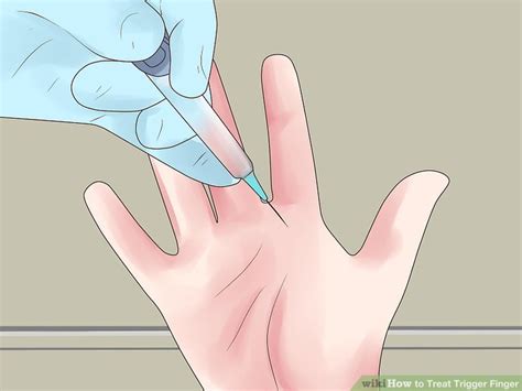 How To Treat Trigger Finger Steps With Pictures WikiHow