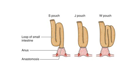 Pouchitis Ibdrelief